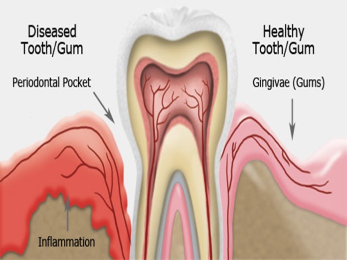 7 Ways to Heal Gum Diseases