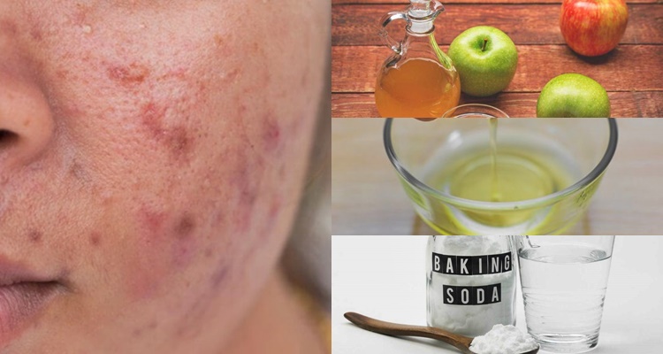 CLEAR SKIN TIPS: Easy Steps To Get Rid Of Acne & Pimple Marks