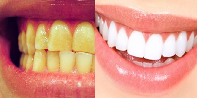 YELLOWISH TEETH TREATMENT: 5 Ways To Whiten Yellowish Teeth