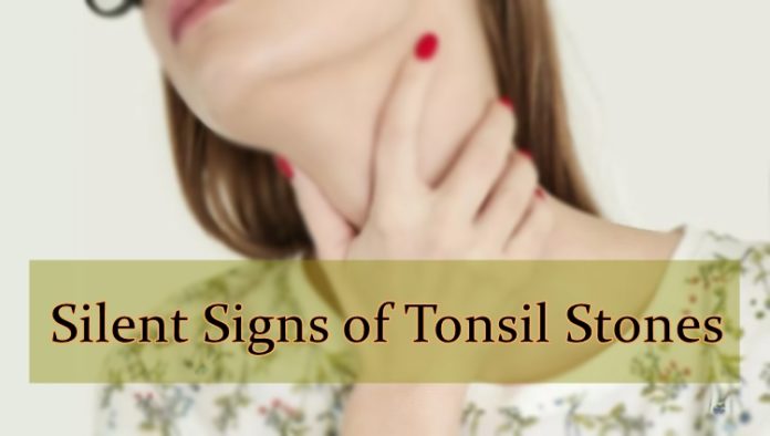 TONSIL STONES: 6 Silent Signs You Should Not Ignore