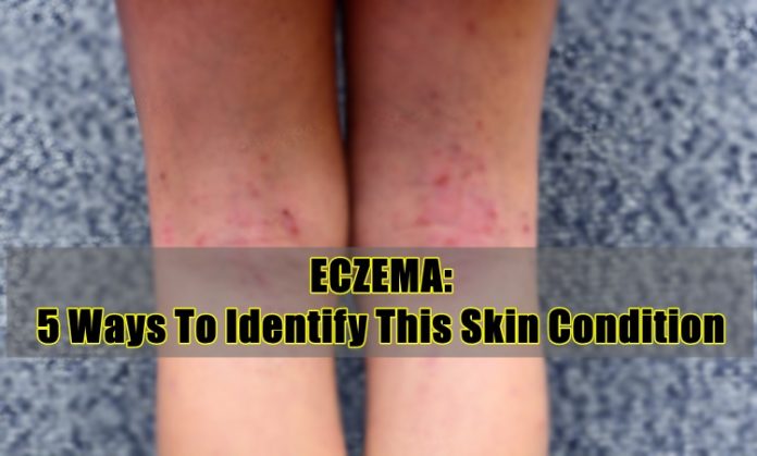 ECZEMA: 5 Ways To Identify This Kind Of Skin Condition