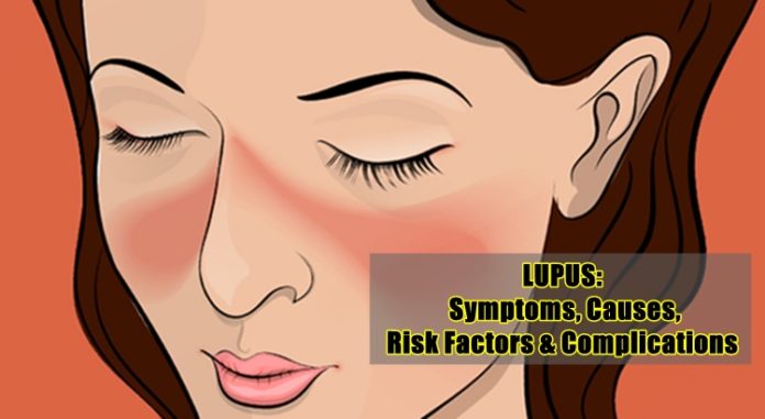 LUPUS: Symptoms, Causes, Risk Factors & Complications