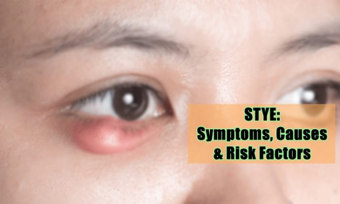 STYE: Symptoms, Causes & Risk Factors Of This Infection