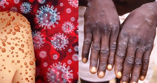 The First Mpox Case of 2024 in the Philippines Reported in Quezon City ...
